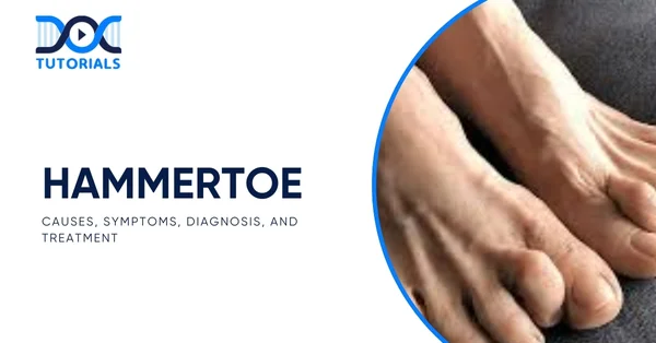 Hammertoe | Causes, Symptoms, Diagnosis, and Treatment