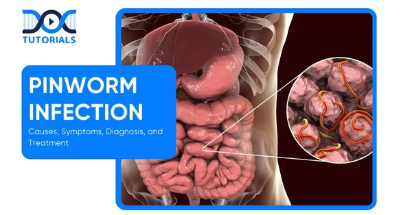 Pinworm Infection | Causes, Symptoms, Diagnosis and Treatment